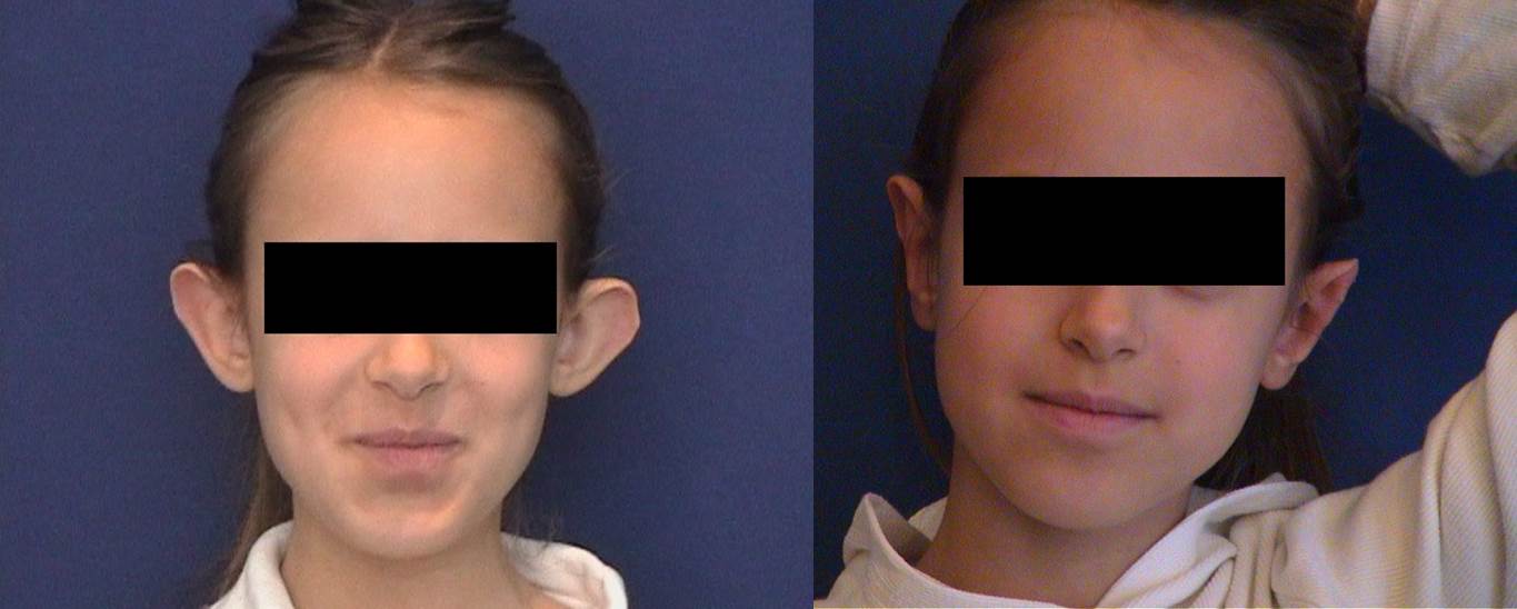 Cas 1 Otoplastie De Face Avant Après | Doctor Knipper